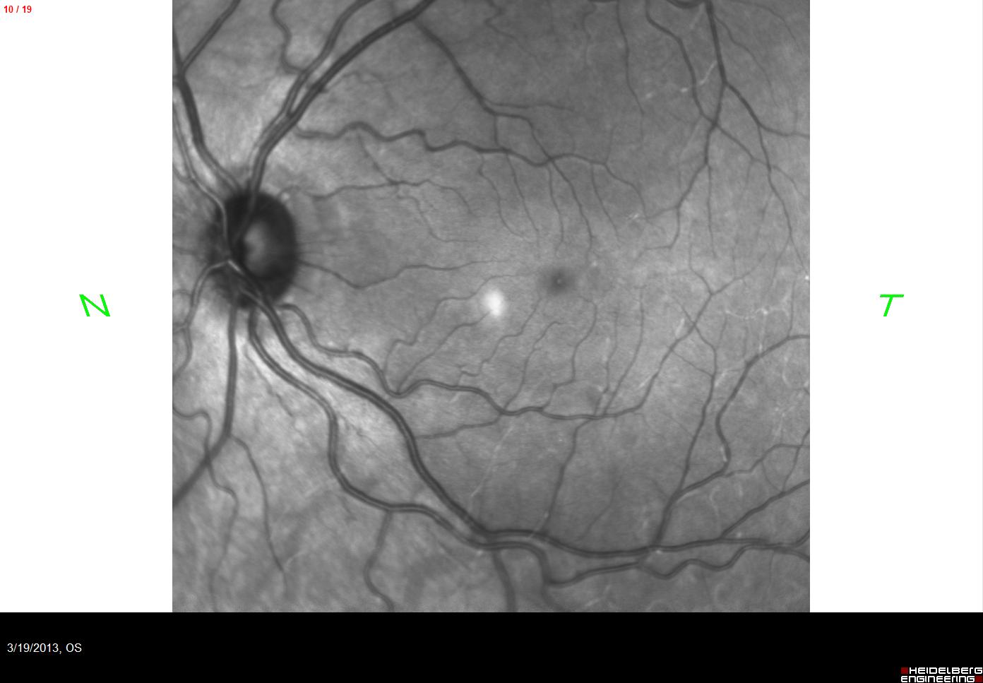 Risk of retinal damage for patients on Elmiron - College of Physicians ...